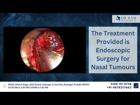 Endoscopic Surgery For Nasal Tumors