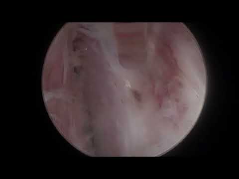 Laser Prostate Surgery (HoLEP) post UroLift