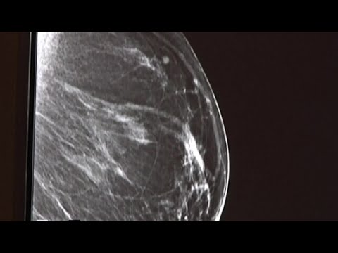 Your Healthy Family: Breast calcifications and DCIS