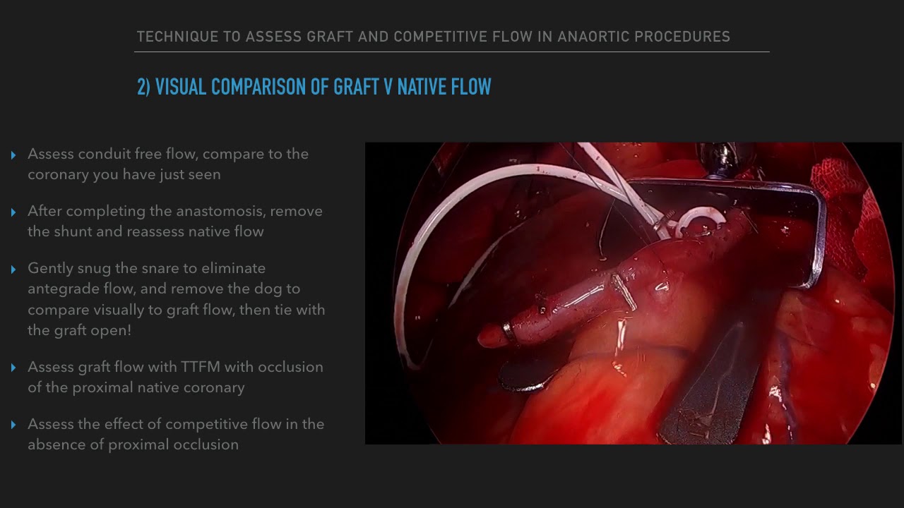 Transit Time Flow Measurement: Answers to 7 common questions with Dr. Brereton