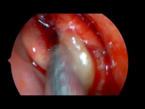 sample surgical video record by UC-100 USB HD endo camera, NSE