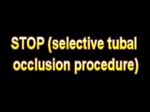 What Is The Definition Of STOP selective tubal occlusion procedure
