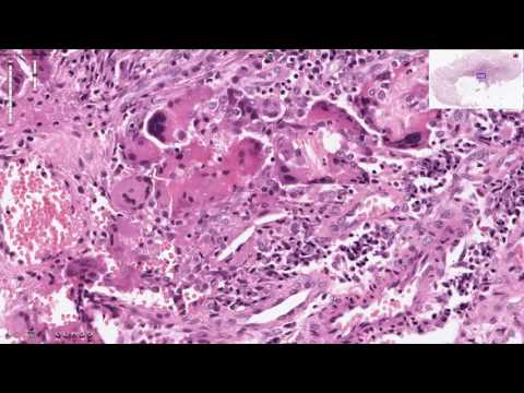 Histopathology - Granulation Tissue