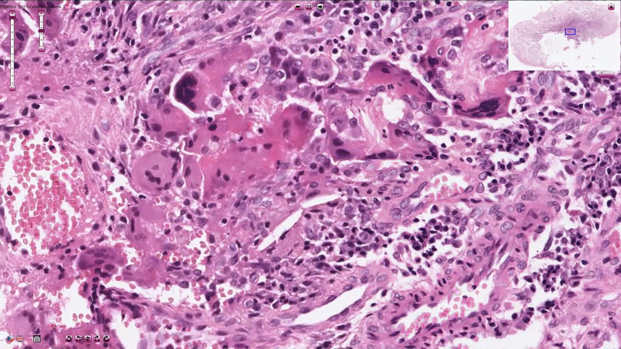 Histopathology - Granulation Tissue