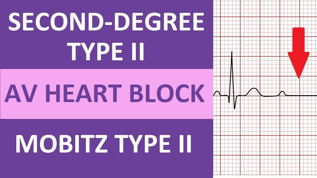 Second-Degree Type 2 Heart Block ECG Rhythm Nursing NCLEX | Mobitz Type II