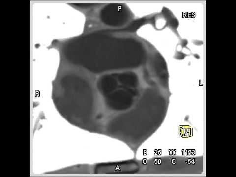 Cardiac: diseased aortic valve with aortic valvular stenosis (7 of 10)
