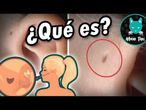 ¿Qué es el HOYO en la OREJA de VARIAS PERSONAS? | Seno Preauricular