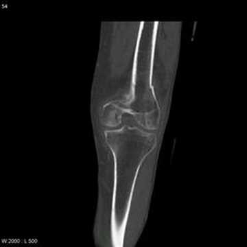 Radiology Rounds: CT Femur Fracture