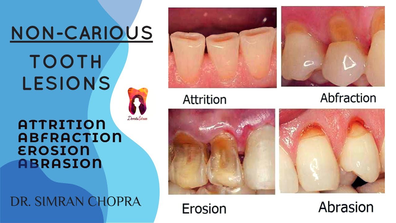 Non Carious Tooth Lesions l Attrition, Abrasion, Abfraction, Erosion l Operative Dentistry