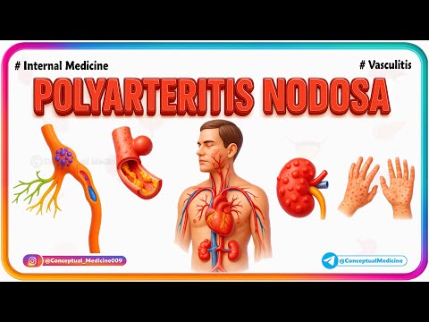 6. Polyarteritis Nodosa (PAN) | Medium Vessel Vasculitis | Internal Medicine