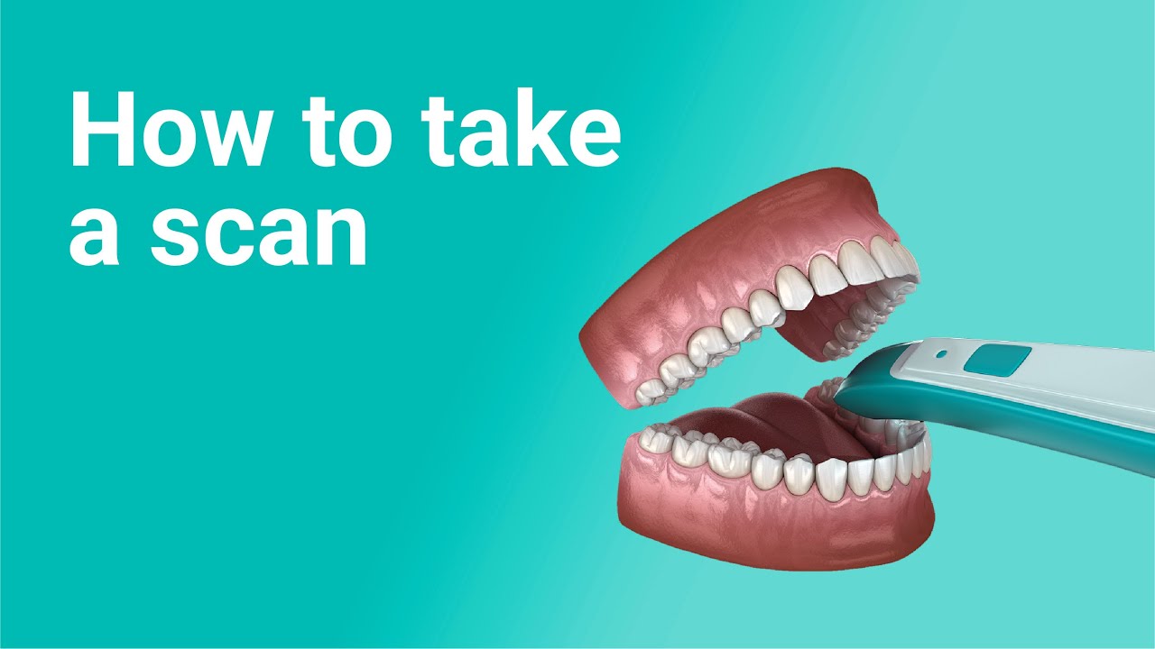 How to Take a Scan for Teeth Made Simple: Intraoral Scanning Technique