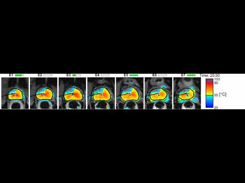 TULSA Real-Time MRI Thermometry and Feedback Control