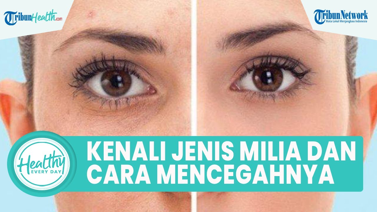 Kenali Jenis-jenis Milia dan Cara Mencegahnya, Simak Ulasan dr ...