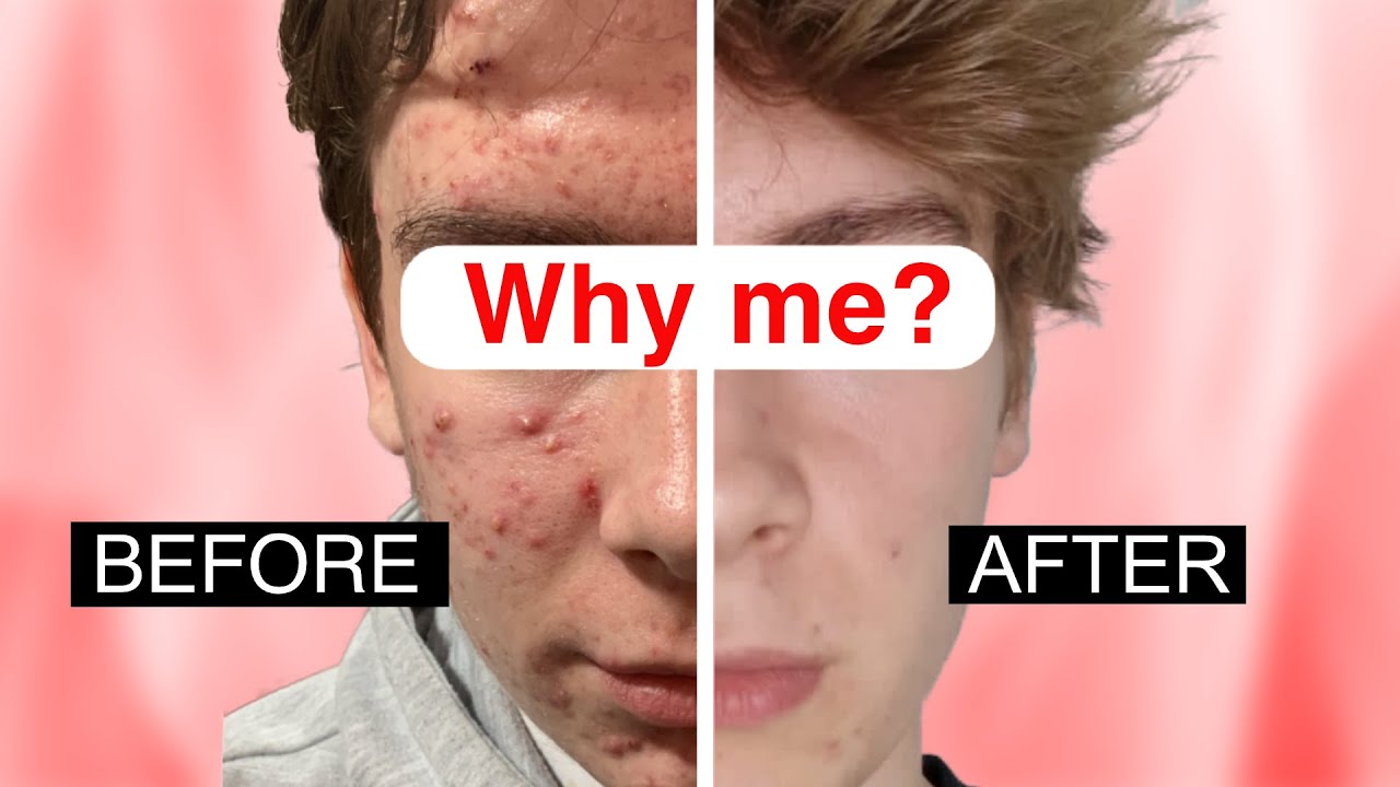 Understanding Teenage Acne & Top Tips to get rid of it!