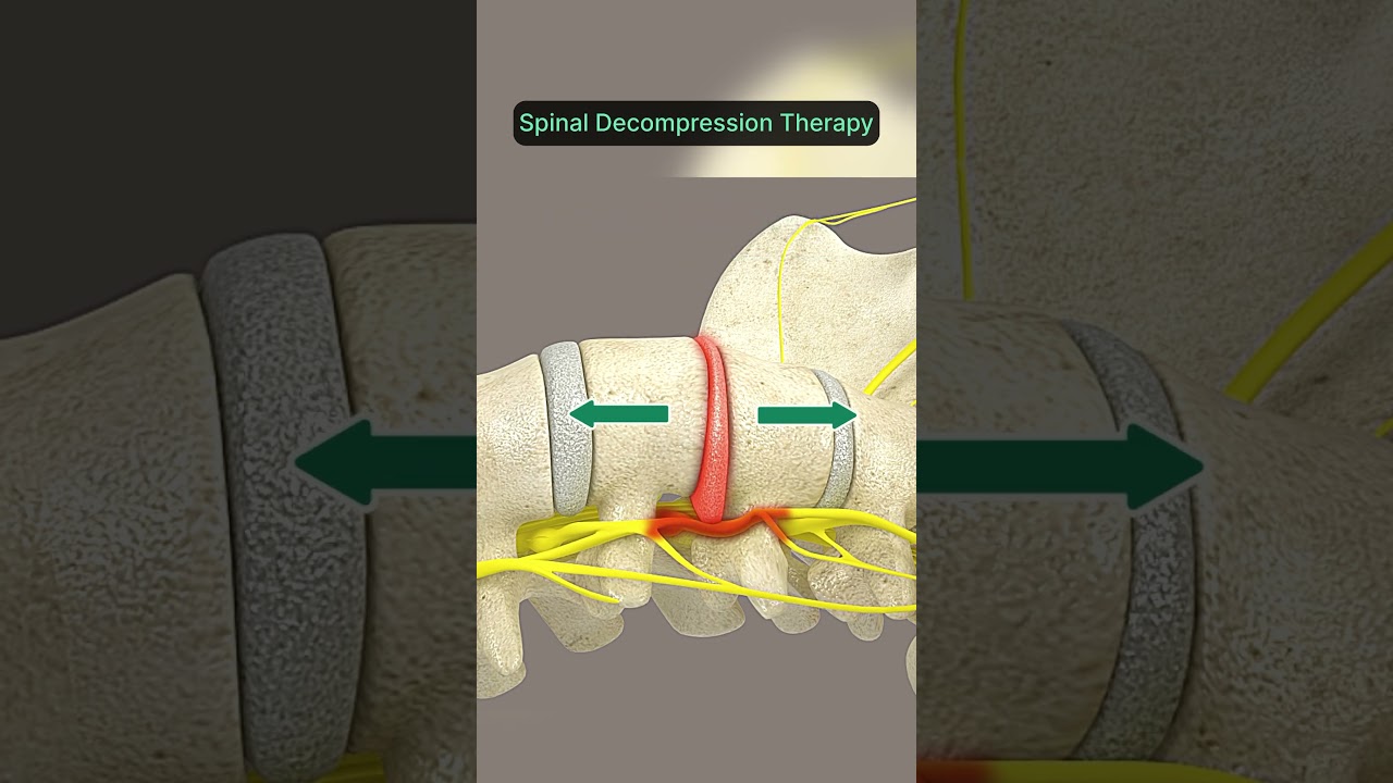 Spinal Decompression for Lower Back Pain and Sciatica #spinaldecompression #sciatica #herniateddisc