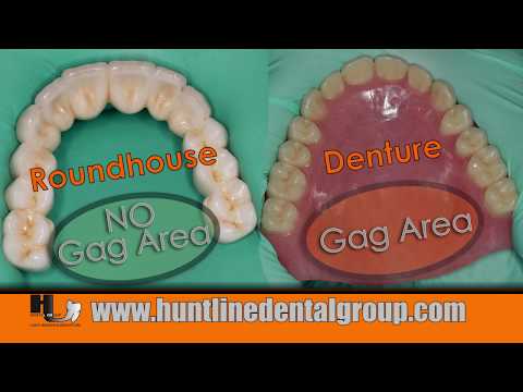 2019 Huntline Dental Group - Zirconia Roundhouse vs Dentures - Mini Split