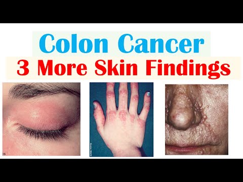 Colon Cancer: 3 Other Weird Symptoms (Found on the Skin)