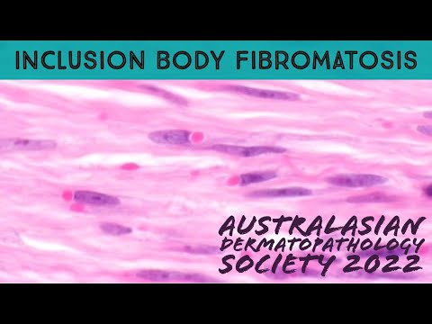 Inclusion Body Fibromatosis (Infantile Digital Fibroma/tosis) in 5 Minutes (dermpath pathology)