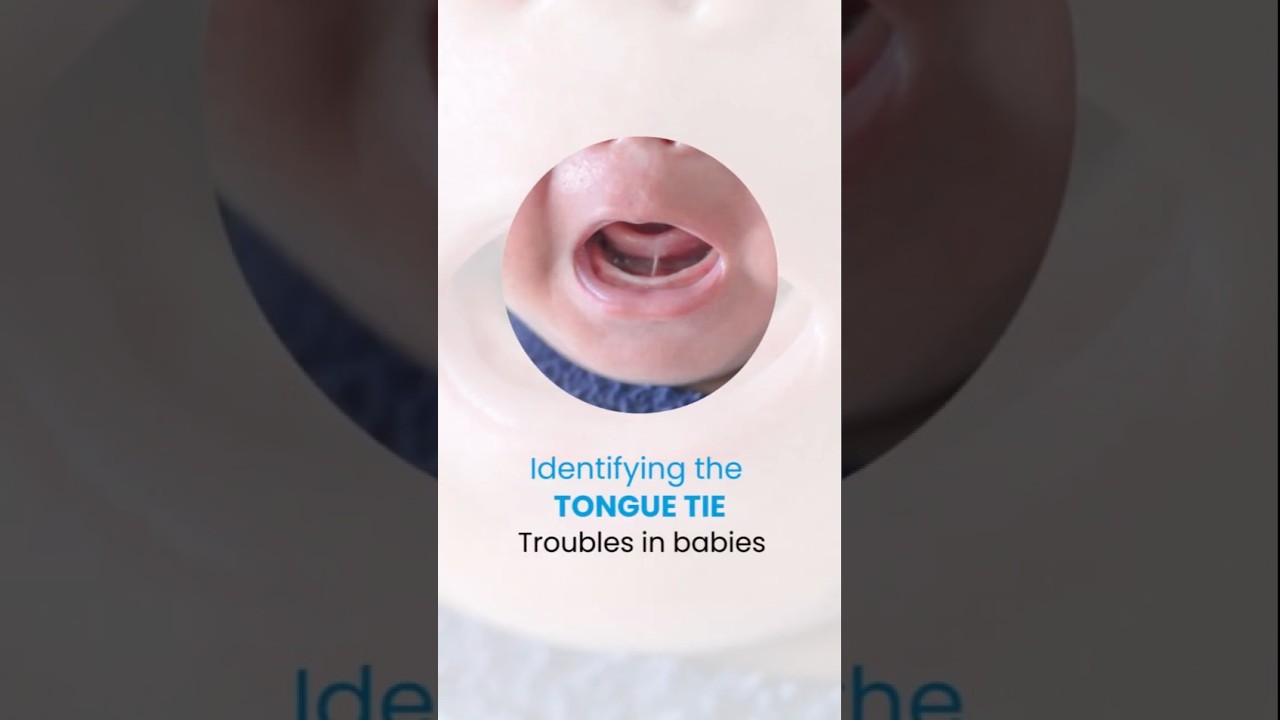 Identifying the tongue tie Troubles in babies | #kigodental #hyderabad