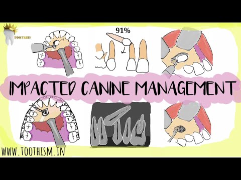 5 ways to manage IMPACTED CANINES | Oral Surgery