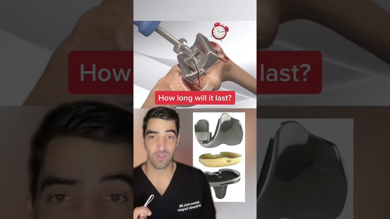 How long will my total knee replacement last? Orthopedic surgeon will talk about this and more