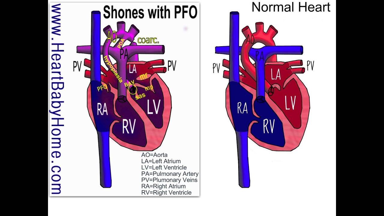 37 Shones Complex with severe coarctation of the aorta