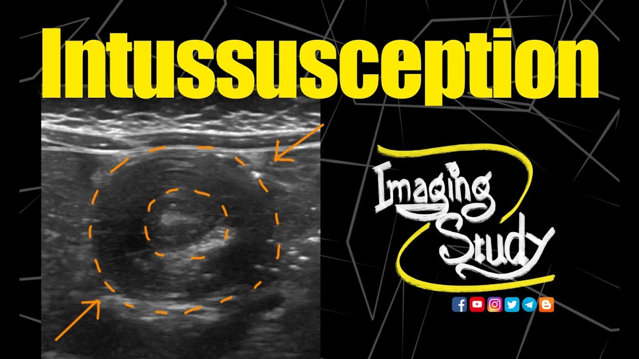 Intussusception || Ultrasound || Case 154