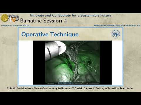Robotic Revision from Sleeve Gastrectomy to Roux-en-Y Gastric Bypass in Setting of Intestinal Ma...