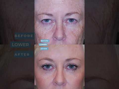 Facial Enhancement with Dr. Duplechain #facelift #blepharoplasty #browlift