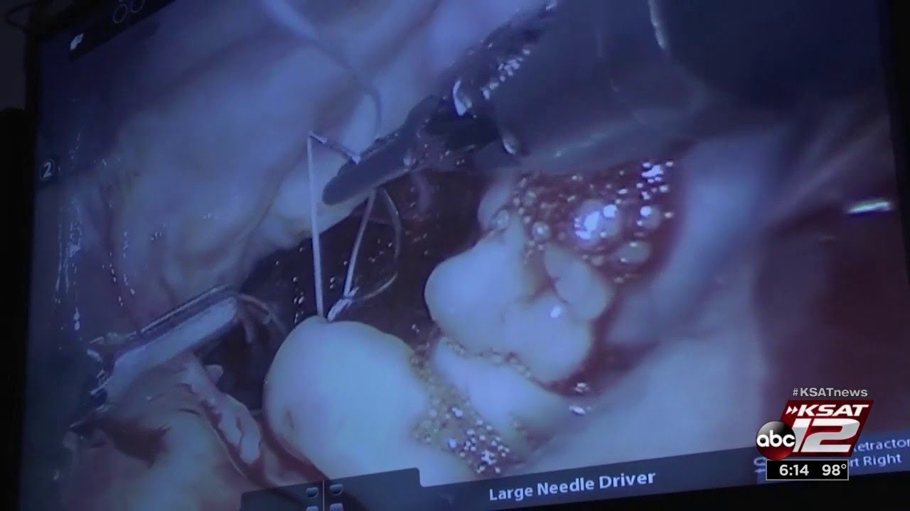 Video: Robotic procedure helps esophageal cancer patients recover faster