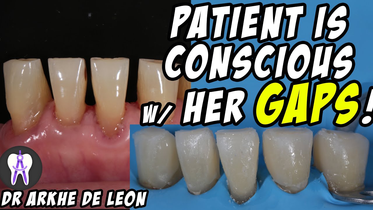 Closing The Patient's Gaps with Direct Composite Technique #C24