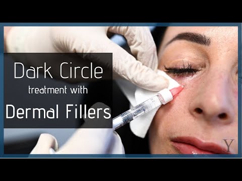 Restylane® Injection for Under Eyes | Atlanta Fillers & Injectables | Y Plastic Surgery