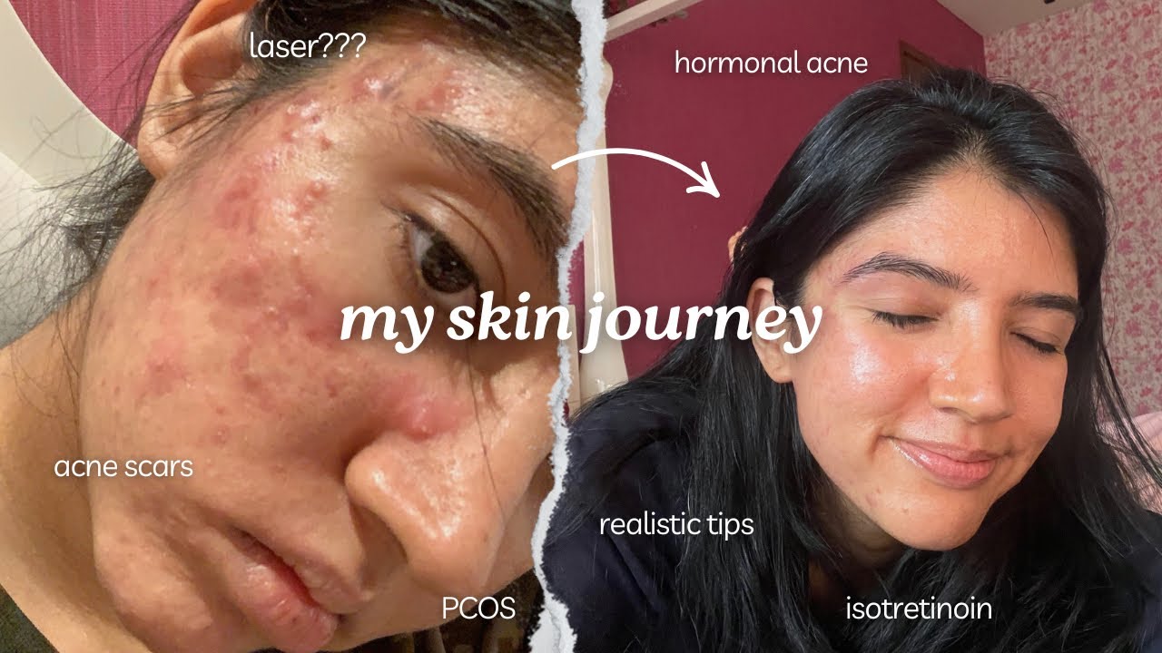 Navigating My Skin Journey: Overcoming Acne, PCOS, and Finding ...