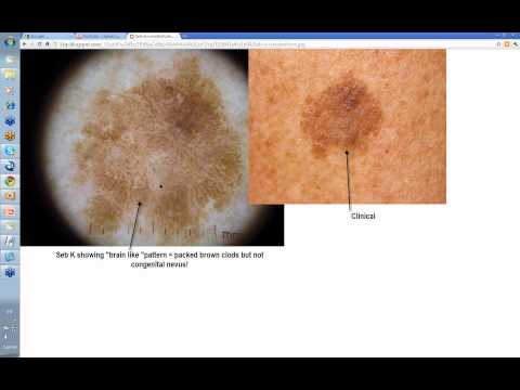 Dermoscopy Made Simple - Seborrhoeic Keratoses