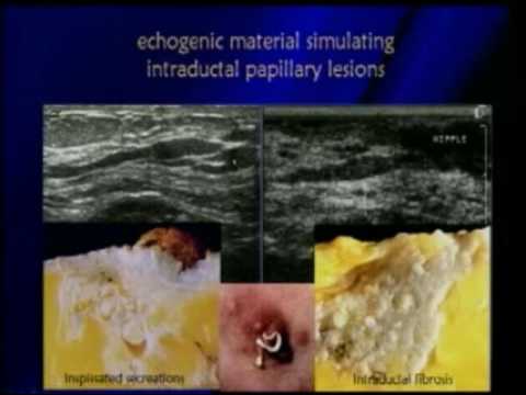 Advanced Breast Ultrasound