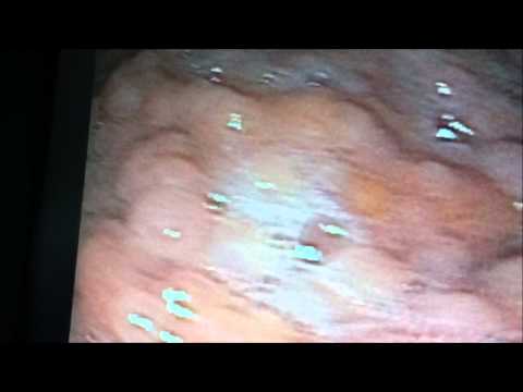 Gastric Polyps