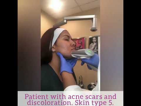 EMatrix is used to reduce the appearance of wrinkles, folds, acne scars and skin laxity.