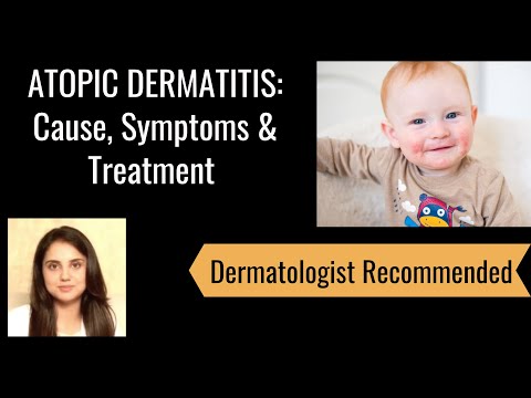 Atopic Dermatitis- Treatment and symptoms II Dr Surbhi, MD