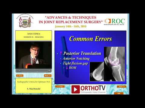 Radiographic Criteria for Optimum TKA Dr S Macdonald