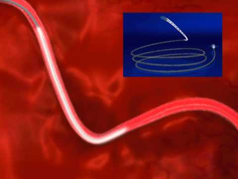 ASAP® Aspiration Catheter