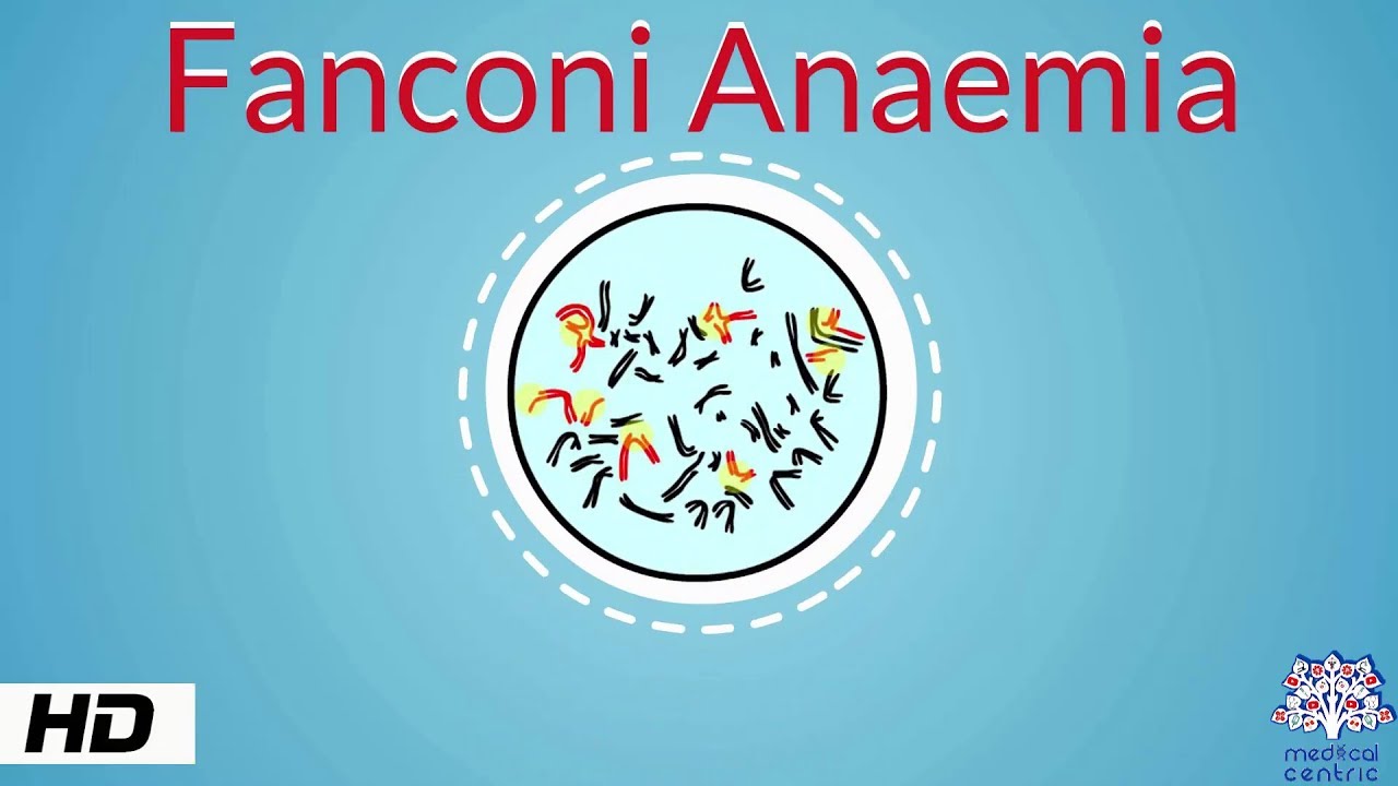 Fanconi anemia, Causes, Signs and Symptoms, Diagnosis and Treatment.
