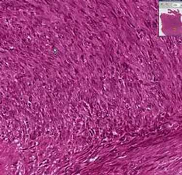 Fibrosarcoma of Soft Tissue - Pathology - Orthobullets