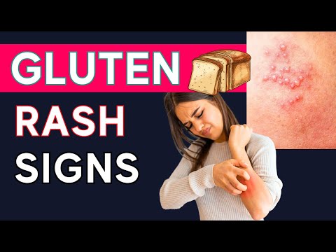 Dermatitis Herpetiformis Explained (Itchy Gluten-Triggered Celiac Skin Rash) | Dr. Peter Lio