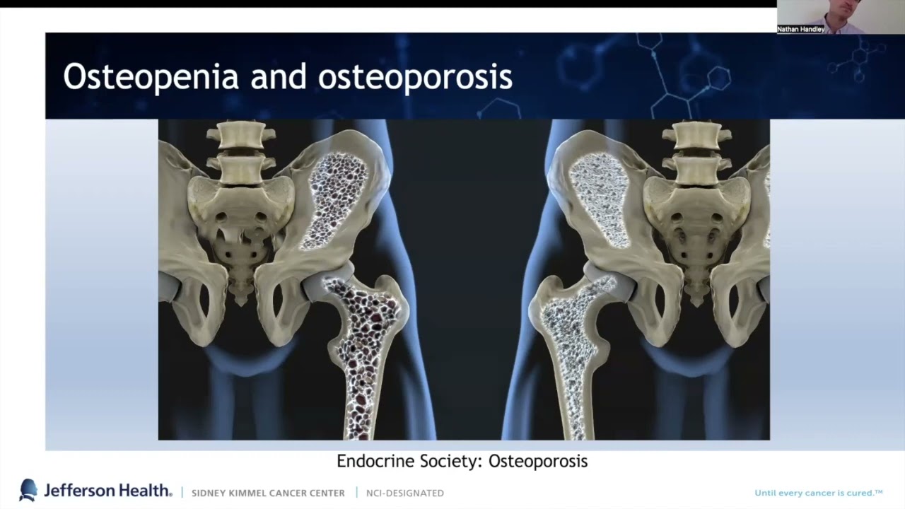 Bone Health Expert Panel – Unite for HER Video Library