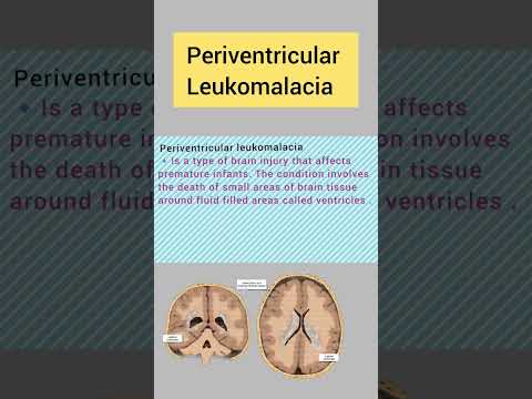 Periventricular leukomalacia #medical #anatomy #physiology #medicalnotes #physiotherapy #physio #tip