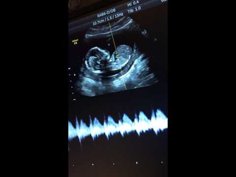Heart rate 173 BPM
