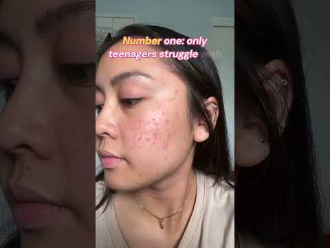 Busting Acne Myths 🔎