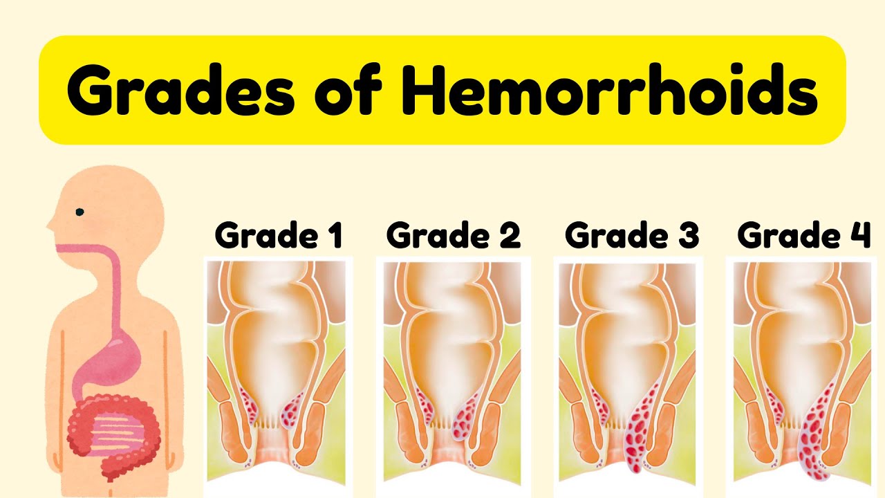Grades of Hemorrhoids (Piles) | Symptoms, Causes & Treatment Overview