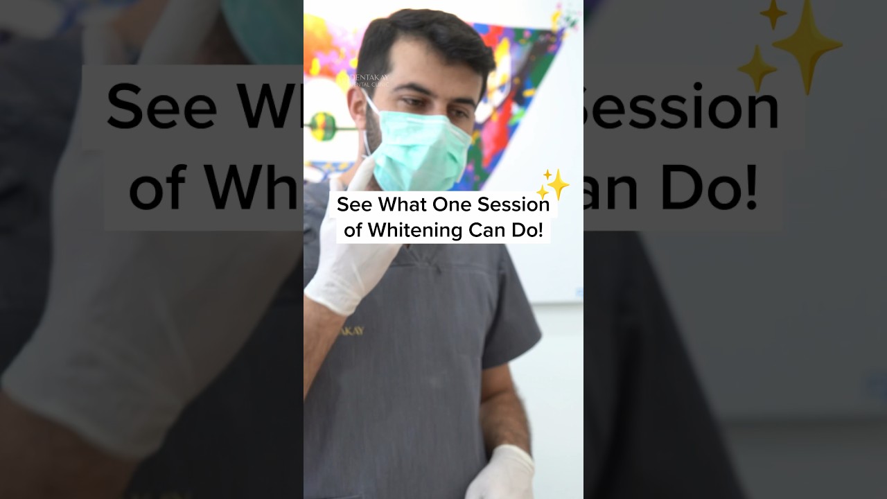 After one session of teeth whitening | Before After results #whiteteeth #teethwhitening #shorts