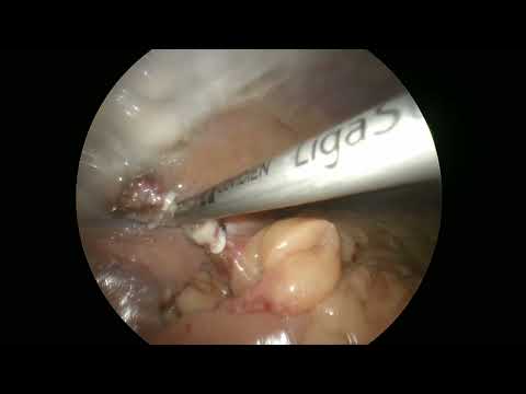 Laparoscopic Appendectomy l Dr Nattapon Passawart